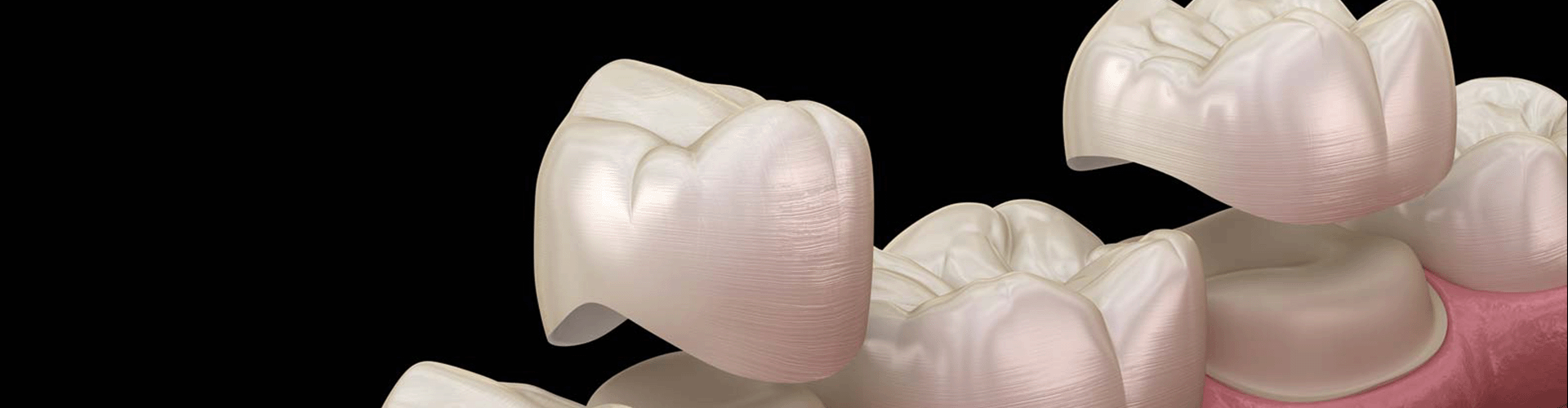 Understanding Dental Crowns: When and Why You Need One